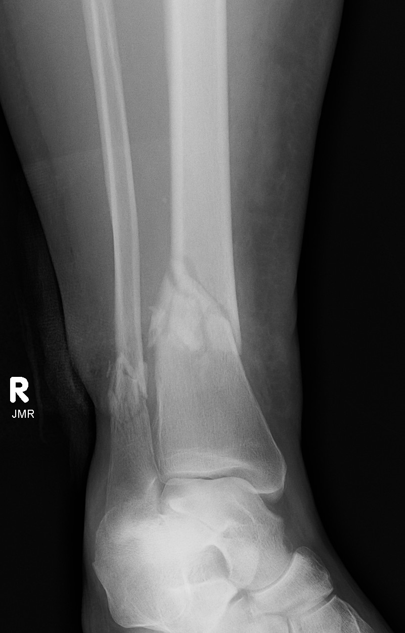 Distal Tibial Fractures | The Bone School